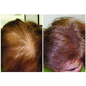 Miracle Plus Thick Hair Shampoo for Thinning Hair for Men and Women 8oz.