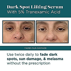 Dark Spot Lifting Serum with 5% Tranexamix Acid