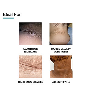 FIXDERMA Nigrifix Cream for Acanthosis Nigricans with Lactic Acid | Dermatologist Tested Retinol Cream | Useful for Dark Body Parts like Neck, Ankles, Armpits & Elbows –3.52 FlOz