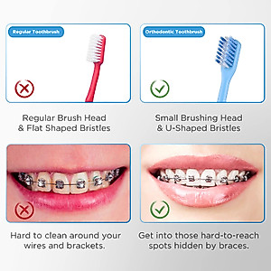 Fremouth V-Shaped Orthodontic Toothbrush for Braces, Soft Bristles, 6 Count, with Interdental Brushes