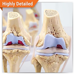 GPI Anatomicals Knee Joint Model Set | Human Body Anatomy Replica Set of 4-Stage Osteoarthritis Knee Joint for Doctors Office Educational Tool