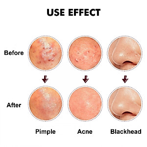 FIXBODY Blackhead and Splinter Remover Tools - Stainless Steel Professional Easily Cure Pimples Whiteheads Comedones Acne Zit Ingrown Hairs and Facial Impurities Bend Head Tweezer Surgical Kit