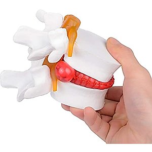 MIIRR Human Lumbar Disc Herniation Model, Vertebral Spine Anatomical Medical Model Perfect for Learning & Teaching Tool - Lumbar Vertebral Spine Model