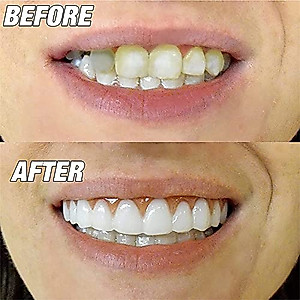 Snap On Teeth You Can Eat With，False Teeth Sets You Can Eat With，Adjustable Snap-On Dentures， Dental Veneers For Temporary Teeth Restoration, Protect Your Teeth And Regain Confident Smile