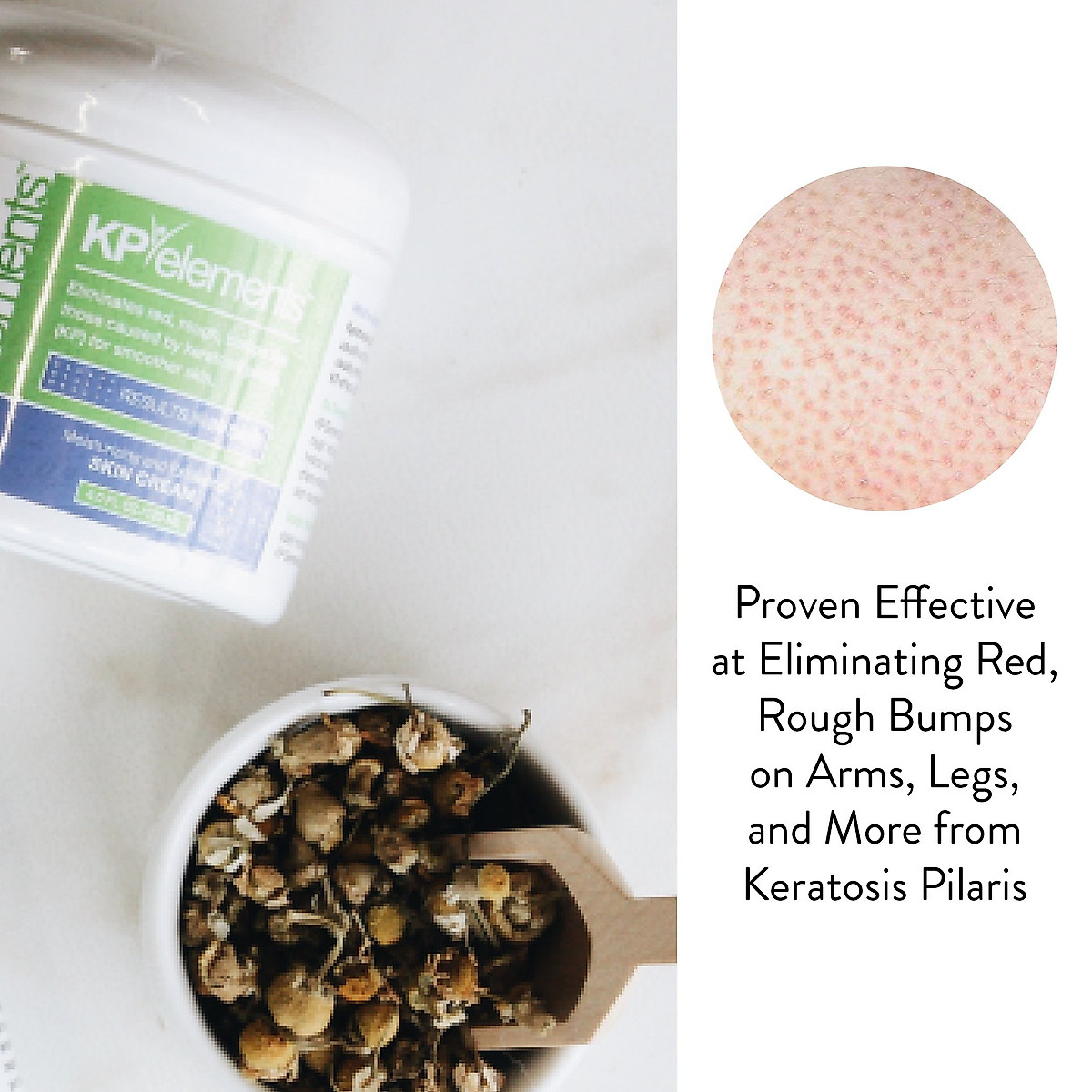 KP Elements Keratosis Pilaris Lotion (4 fl oz) - Natural Keratosis Pilaris Treatment, Moisturizing & Exfoliating AHA Lotion for KP, Vegan, Made in USA