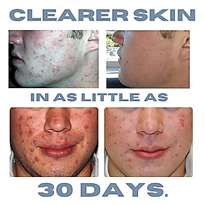 Clearogen Hormonal Acne Solution Natural Anti-DHT Ingredients Deluxe Set Original Formula Benzoyl Peroxide 2 Month Supply 3 Piece Set