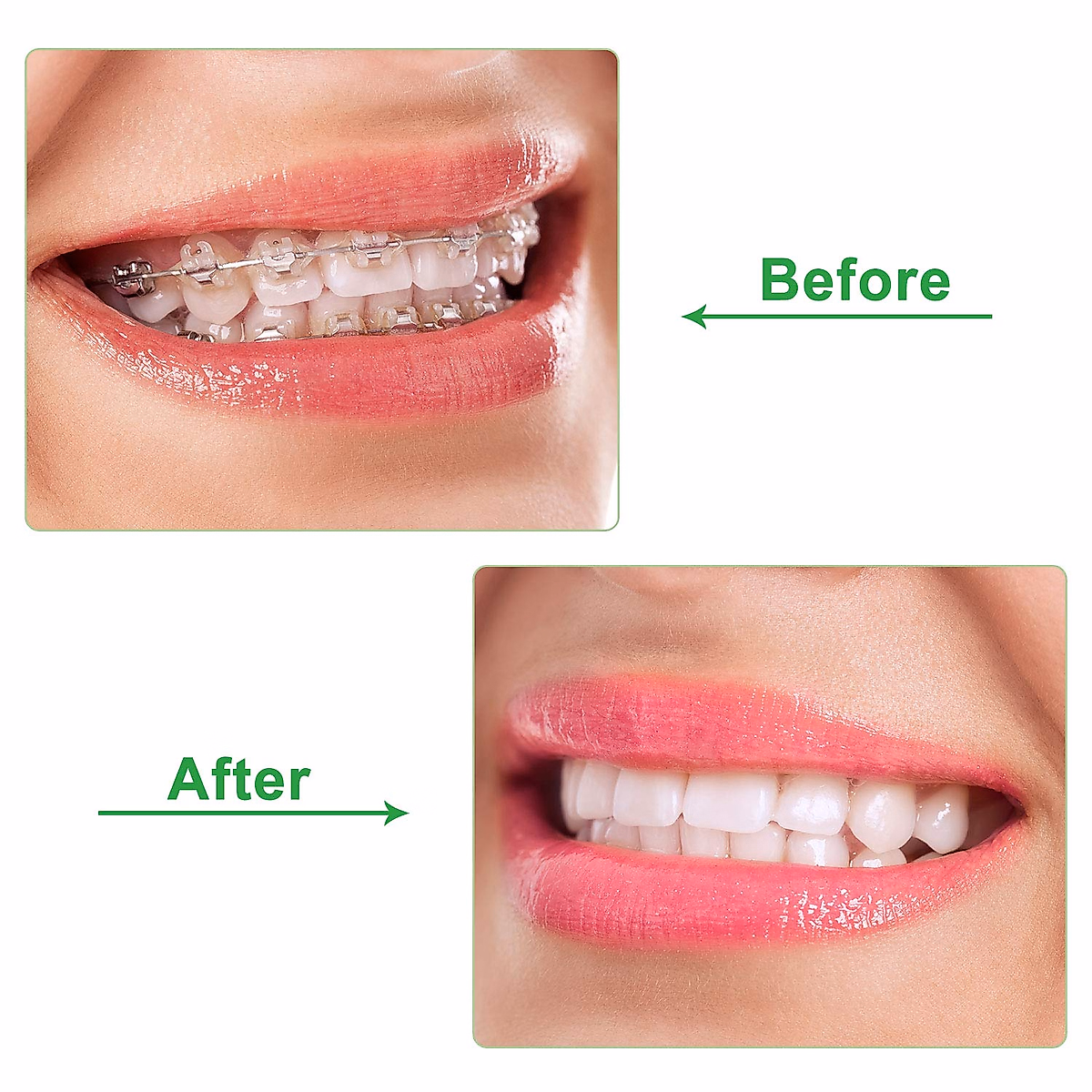 10 Pieces Aligner for Aligner Chompers Aligner Trays Seater Orthodontic Dental aligner(Green)