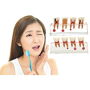 Dentalmall Dental 4-Stage Endodontic Treatment Model for Study Teach Teeth Model 4018 Root Canal Anatomy Demonstration Teaching Tooth Model