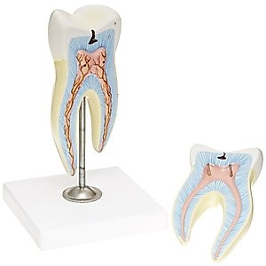 Eisco Labs Upper Triple Root Molar with Caries Model, Enlarged 15 Times, 2 Parts