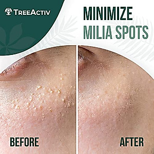 Treeactiv Overnight Milia Spot Treatment 0.5oz, Improves Milia Overnight, Effectively Treat Milia Blemishes in 2 Weeks, Natural Milia Treatment, 120+ Uses