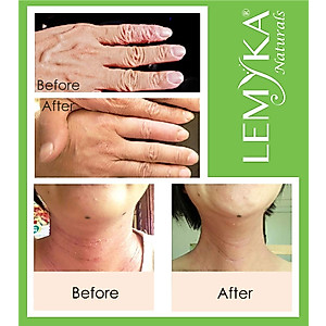 LEMYKA Eczema Flare Defense Natural Calming Cream - 3 Pack Bundle, for Infants, babies, kids, and adults with Eczema (Atopic Dermatitis), Dry Itchy Patches, Skin Rashes, Steroid Free