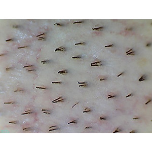 Firefly DE350 Wireless Polarizing Dermatoscope