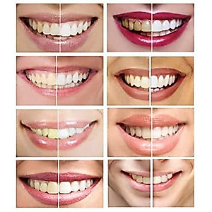 White Teeth Global 10 Syringes (3ml) New Strongest 44% Carbamide Peroxide Teeth whitening Gel