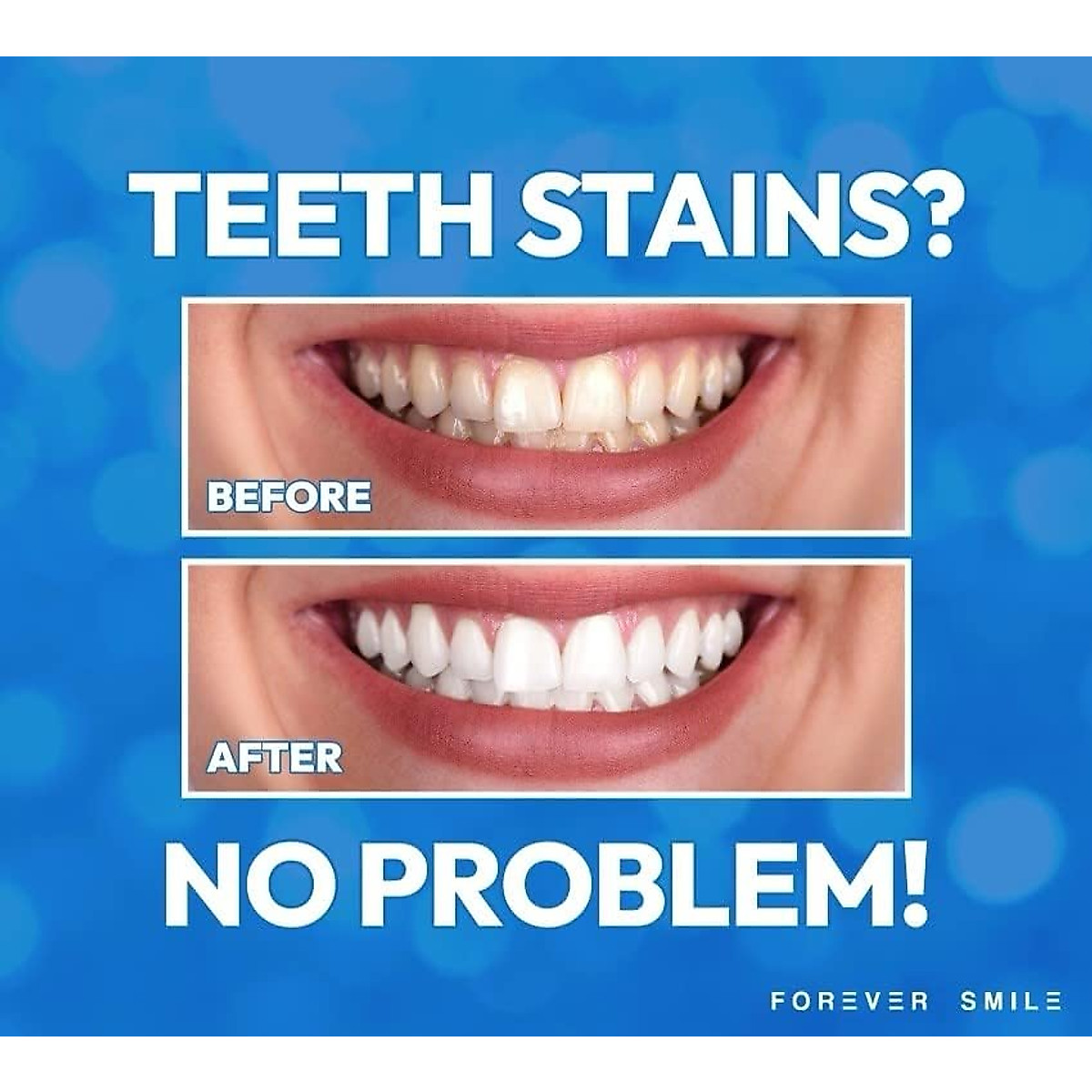 Forever Smile 5X LED Teeth Whitening Kit for Sensitive Teeth. Complete and Effective at Home Teeth whitening kit.