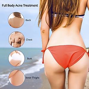 Tobcharm Back Acne Treatment, Butt Acne Clearing Treatment, Body Acne Treatment with Azelaic Acid 3.4 fl. oz., Great for Men and Women Acne Scar Treatment, Hormonal Acne And Cystic Acne Treatment