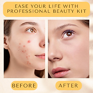 [16 Pcs] Blackhead Remover Tools 2024 Latest Pimple Popper Tool Kit | Stainless Steel Professional Pimple Extractor Tool Kit for Blackheads, Blemish, Comdone, Acne, Zit, and Whiteheads for Face & Nose