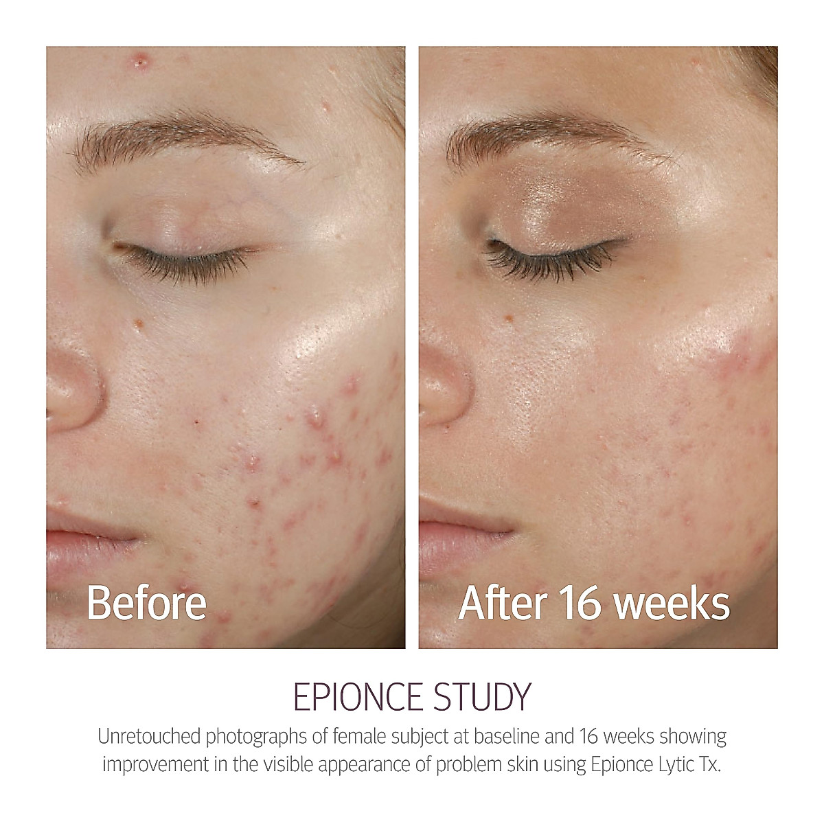 Epionce Lytic Tx - Moderate-Strength Product for Normal to Combination Skin with Salicylic Acid, Hyaluronic Acid & Azelaic Acid, Dermatologist Skincare