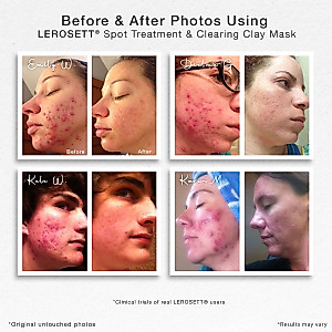 LEROSETT Facial Clay for Acne, Spot Treatment & Clay Mask, For Oily & Congested Skin, Reduces Blemishes, Blackheads & Pimples, Removes Ingrown Hairs, Tighten Pores, Vegan, 650+ Uses