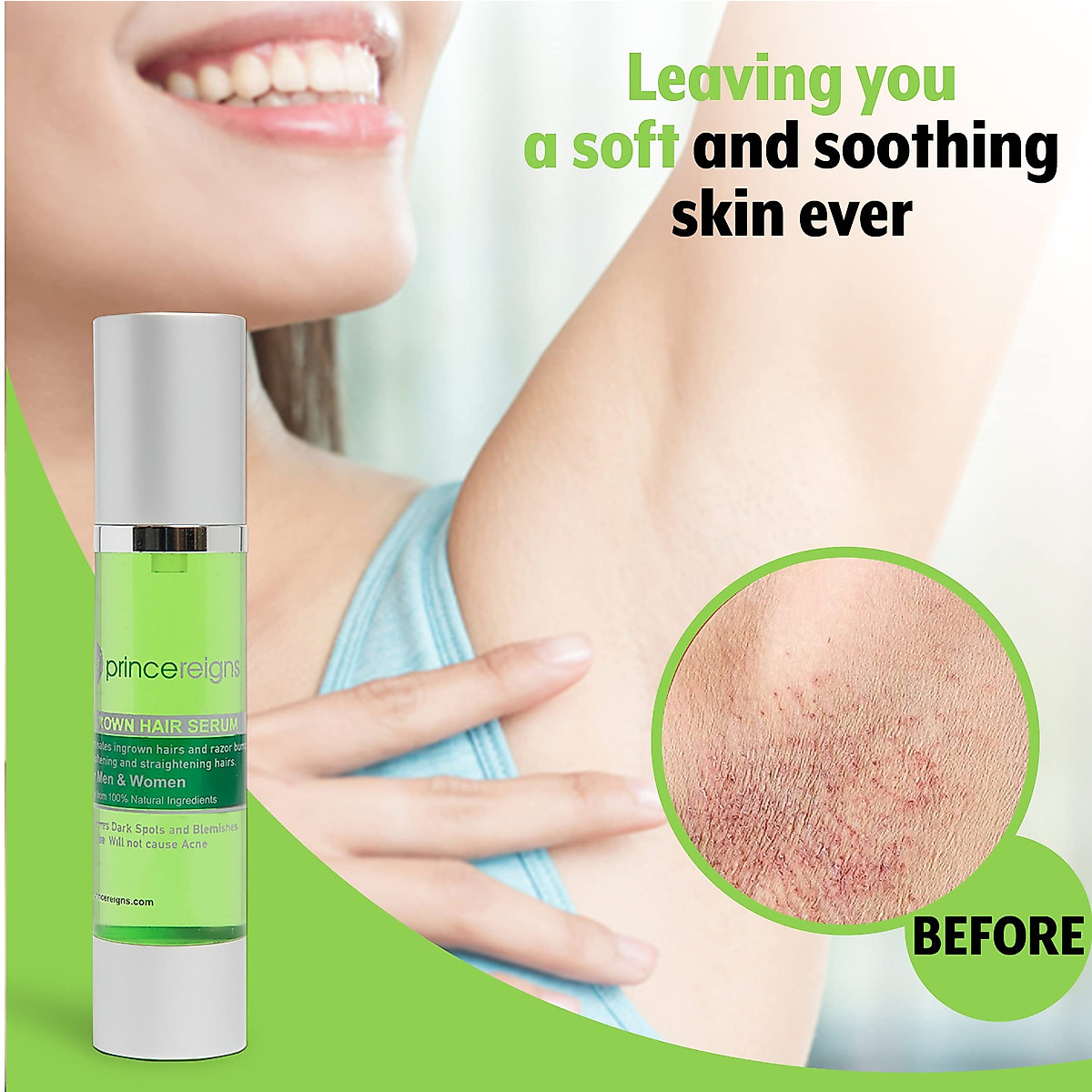Princereigns Ingrown Hair Serum - Organic Razor Bump & Redness Solution for Men & Women, Ideal for Face, Bikini, Legs, Underarm, Prevents Future Ingrown Hairs, No Alcohol or Oils - 2 Fl. Oz