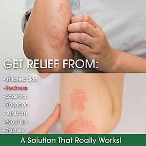 Manuka Honey Cream - Eczema Honey Cream - Moisturizer Lotion Treatment for Eczema & Psoriasis - Ultra Soothing Relief - Face & Body Care, Itchy Dry Skin Rash Healing Ointment for Adults & Kids 4oz