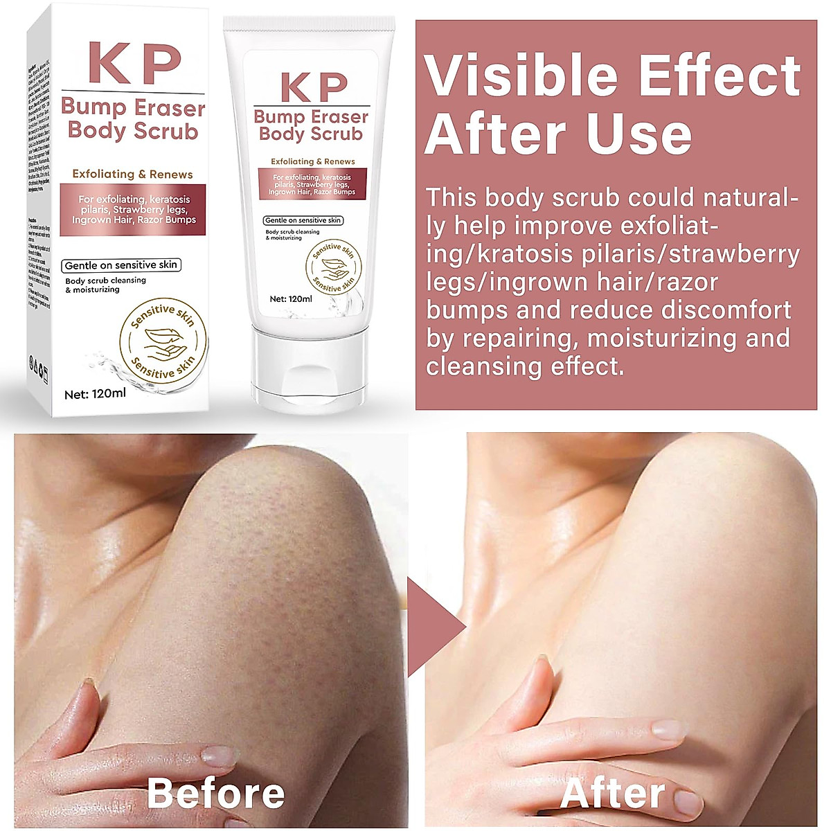 Exfoliating Body Scrub, Keratosis Pilaris Treatment, Body Scrub Exfoliator