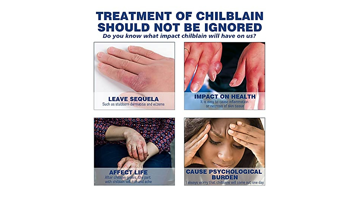 LONGLUAN Chilblain Cream - Deep Moisturizer for Cracked Skin