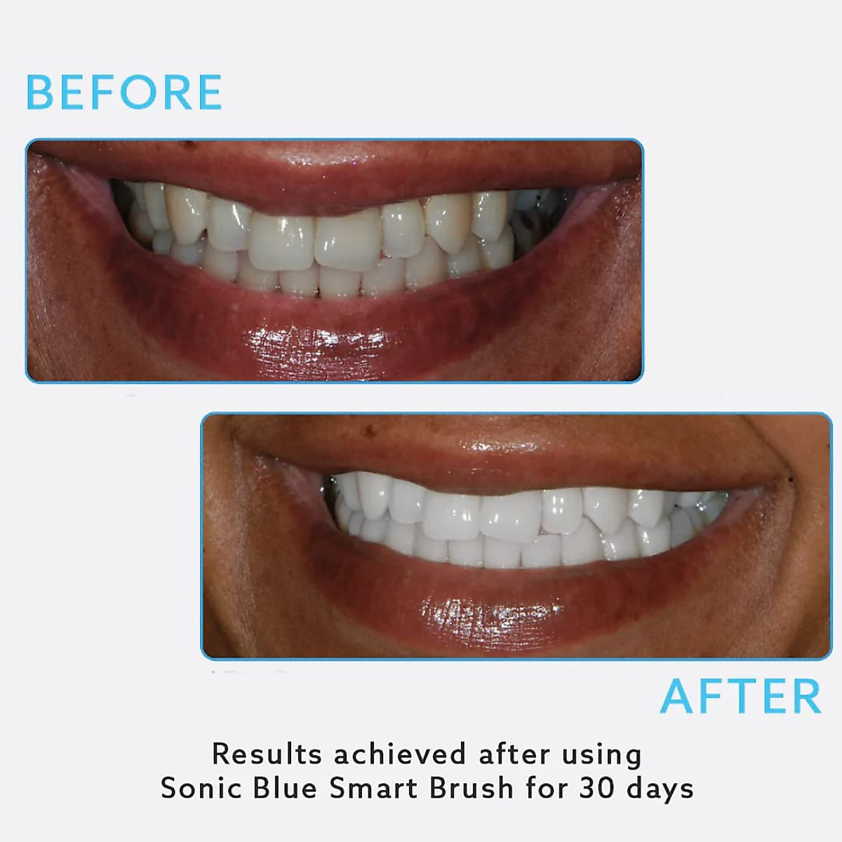 Go Smile Smart Sonic On-The-Go Blue Light Technology Whitening Kit - Dentist Recommended Electric Toothbrush & Professional Tooth Enamel Whitener & Stain Remover Whitening Gel - No Sensitivity, White