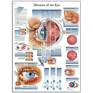 3B Scientific VR1231UU Glossy Paper Diseases of The Eye Anatomical Chart, Poster Size 20" Width x 26" Height
