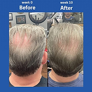 Fortero Carbonic Acid Shampoo for Hair Growth and Treating Hair Loss - AMAZON EXCLUSIVE PACKAGE- Thickening Hair Growth Shampoo with Thin, Dry or Damaged Hair, Anti Dandruff (Large, 300g)