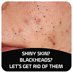 Asepxia Activated Charcoal Cleansing Bar for Enhanced Acne Control & Skin Purification with 2% Salicylic Acid, Ideal for Oily Skin and Reducing Blackheads - 4 Oz, 5-Pack