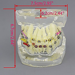 Smile1000 Dental Malocclusion Orthodontic Treatment Teeth Model with Metal Brackets Wires Colorful Ties Chains and Hoops M3005