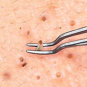 Beaute Galleria Premium Stainless Steel Bend Curved Blemish Extractor Tool for Remove Comedones Whitehead Blackhead Acne Pimple