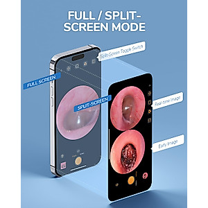 ScopeAround Otoscope Ear Camera, Ear Wax Removal Tool 1080p FHD Video Otoscope, 3.9mm Ear Wax Removal Camera with 6 LED Lights Visual Ear Scope, Compatible with iPhone15 & Android