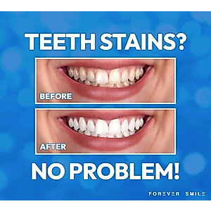 Forever Smile 5X LED Teeth Whitening Kit for Sensitive Teeth. Complete and Effective at Home Teeth whitening kit.