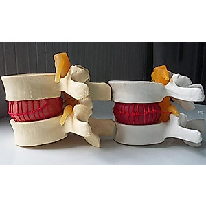 New 2pcs Anatomical Human Lumbar Vertebrae Degenerative Lumbar disc herniation demonstration model Human spine Sold by East Dental