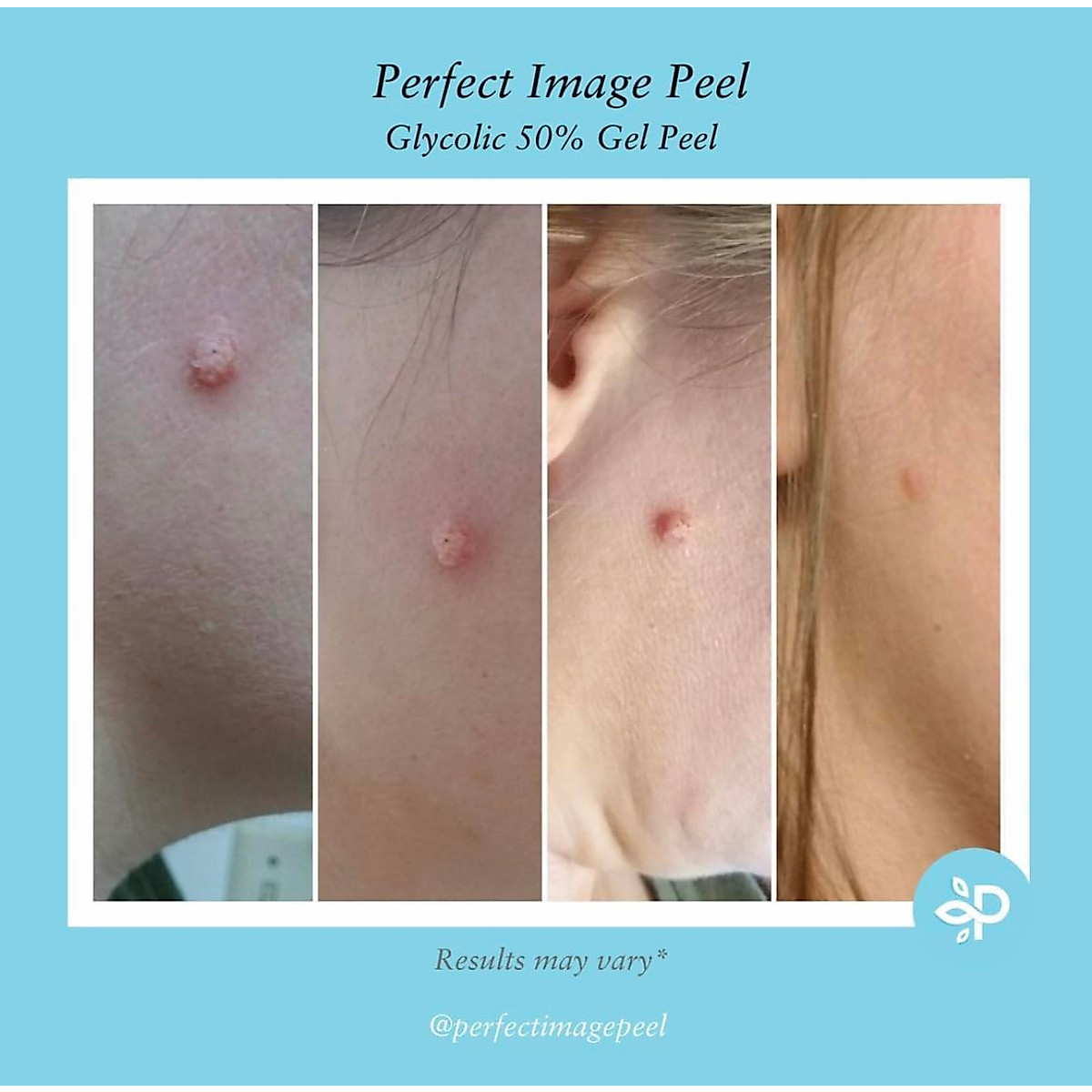 Glycolic Acid 50% Gel Peel - Enhanced with Retinol & Green Tea Extract (Professional Skin Peel)1 ounce