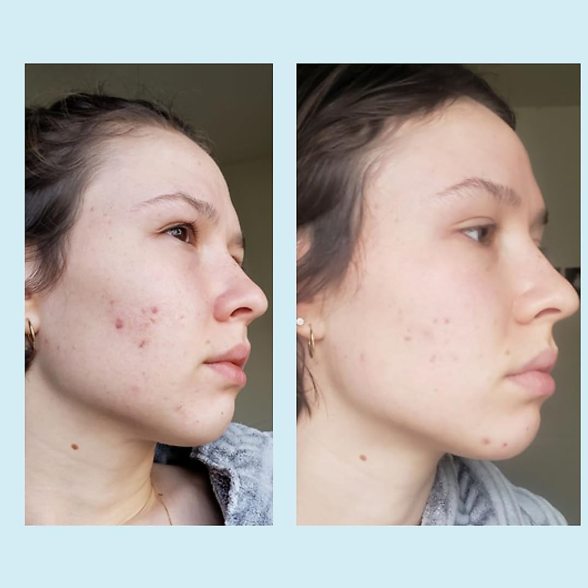 Glycolic Acid 50% Gel Peel - Enhanced with Retinol & Green Tea Extract (Professional Skin Peel)1 ounce