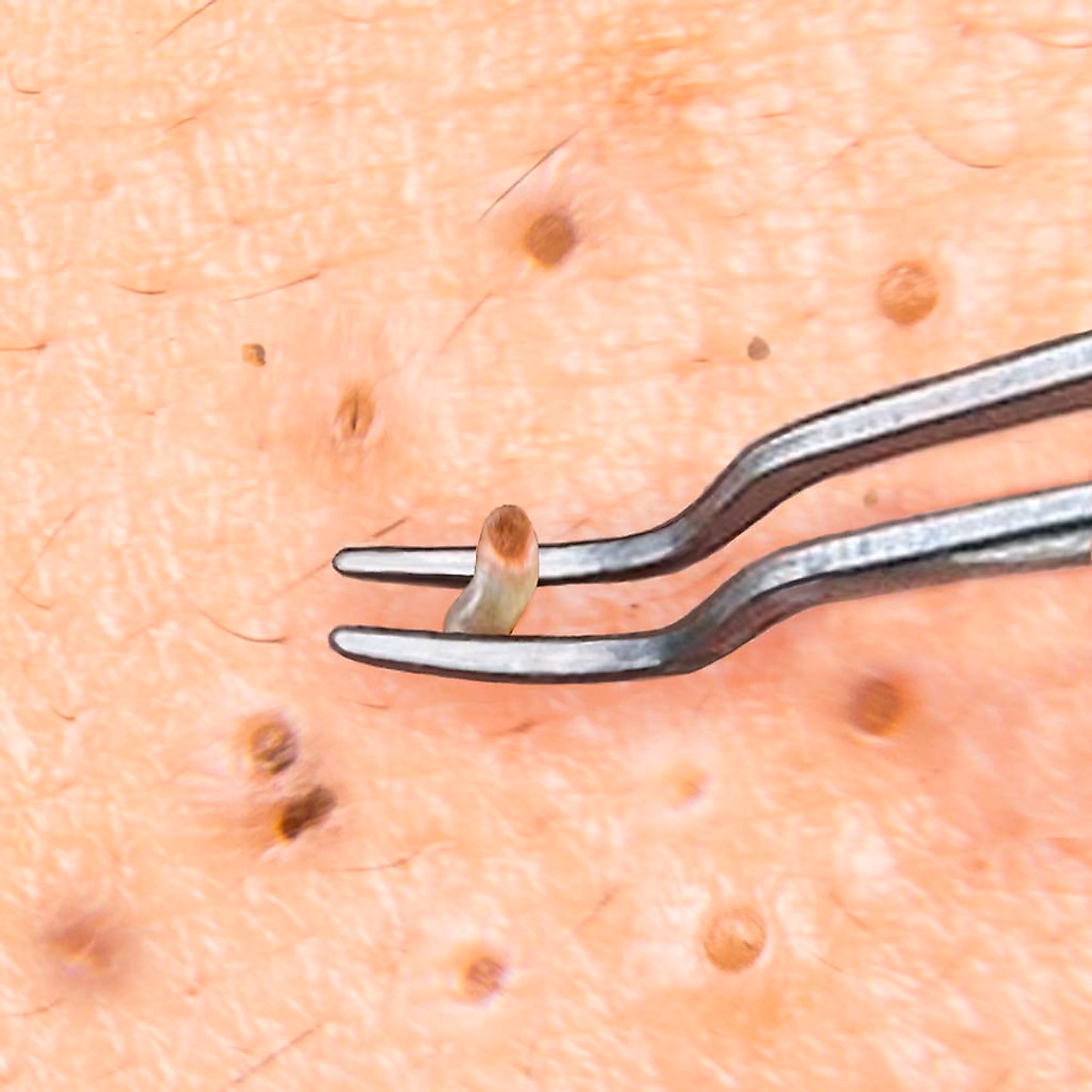 Beaute Galleria Premium Stainless Steel Bend Curved Blemish Extractor Tool for Remove Comedones Whitehead Blackhead Acne Pimple