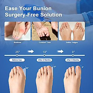 Bunion Corrector for Women Big Toe, Bunion Relief, 8pcs Toe Separators for Overlapping Toes Women, Toe Spacers For Feet Men, Bunion Splint w Pad, Hallux Valgus Toe Straighteners,Fix Bunions No Surgery