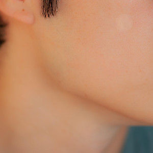 SMARTMED Cover Dot Acne Care (120 Dots) Skin Blemish Treatment with Hydrocolloid | Clear, Waterproof Patch | Oil and Pimple Absorbing | Made in USA