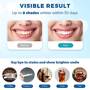 SINORIKO Teeth Whitening Kit with 6X LED Light for Sensitive Teeth 10 Min Fast Result, 3 Carbamide Peroxide Whitening Gel 1 Remineralizing Gel, Mouth Tray with Case, Home Teeth Whitener