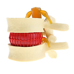 BONEW 4PCS Magnify 2X Human Spine Lumbar Vertebrae Degenerative Disc Medical Model