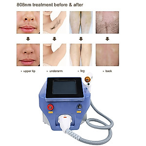 Portable 808 Diode Hair Removal Machine (3 wavelengths: 755nm/ 808nm/ 1064nm)