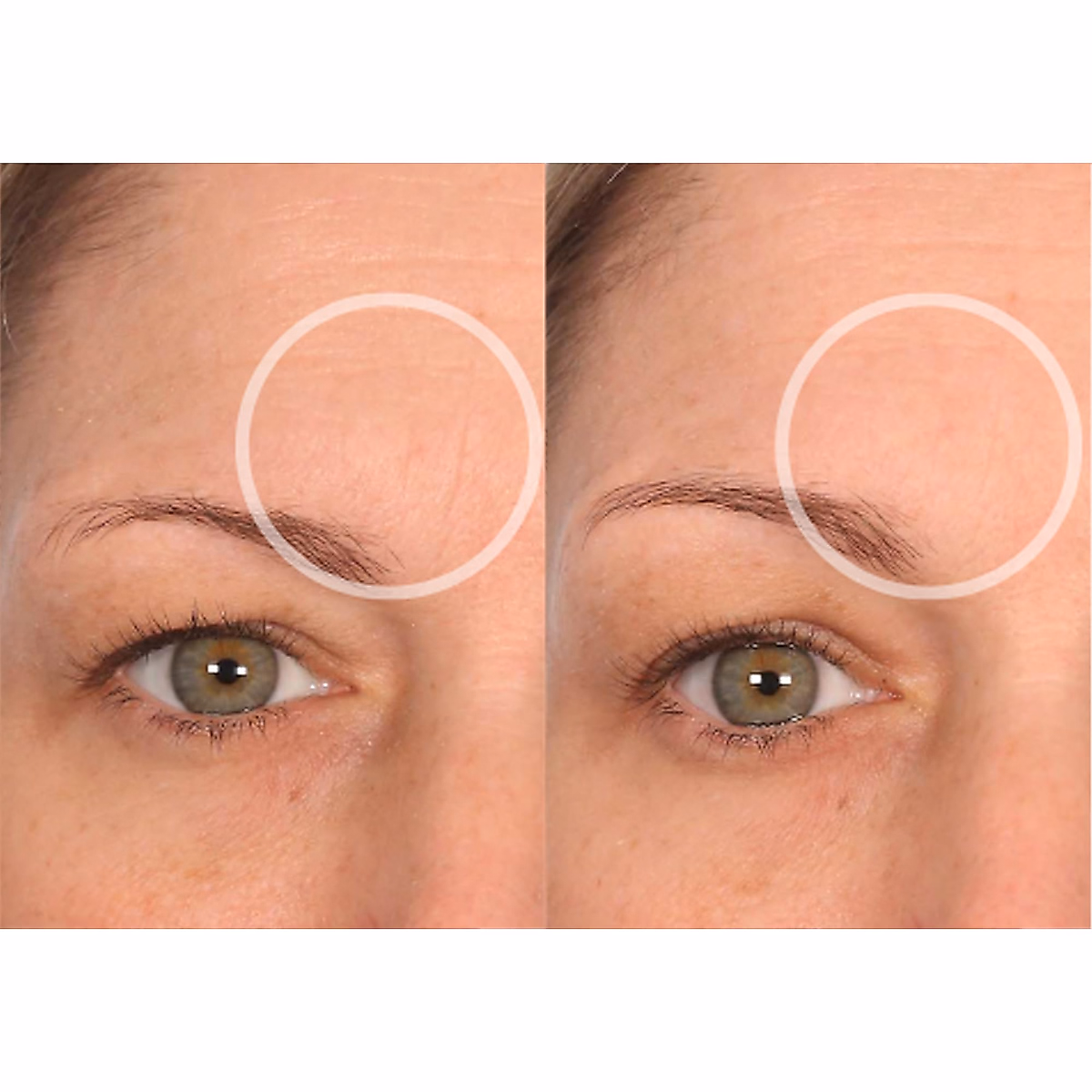 SiO Beauty FaceLift - Reusable Anti-Wrinkle Patches for Neck, Forehead, Eye & Smile - Overnight Smoothing Silicone for Fine Lines, Wrinkles, and Aging