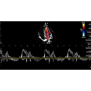 Philips Lumify S4-1 Phased Array Transducer, Portable Ultrasound Solution