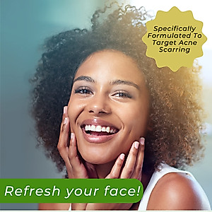 Keeva Organics Intensive Acne Scar Removal Treatment Cream For Acne Scars - 7X Faster Healing Results - Secret Tea Tree Oil Organic Ingredients - For Face, Back and Butt - From