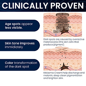Dark Spot Remover for Face & Body | Melasma Cream & Age Spot Remover | for Skin Discoloration, Post-Blemish Marks, Scars & Spots | Cream for Dark Spots