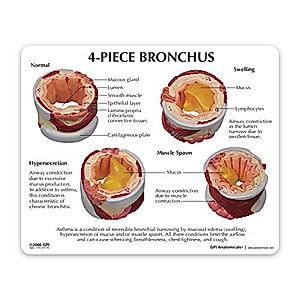 GPI Anatomicals - 4-Piece Bronchus Model | Human Body Anatomy Replica of Respiratory System w/Conditions for Doctors Office Educational Tool