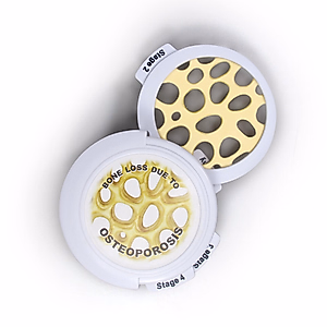 Osteoporosis Model | Human Body Anatomy Four Piece Hinged Disk Set of Progressive Bone Thinning for Doctors Office Educational Tool | GPI Anatomicals