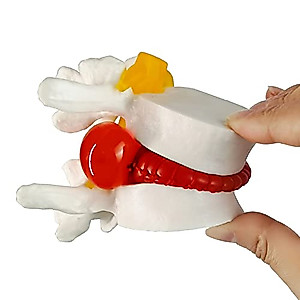 2023 New Human Anatomical Lumbar Herniation Model, Vertebrae Degenerative Lumbar Human Spine Model 1PCS,Lumbar Spine Model for Teaching & Learning - Excellent Way for Demonstrating Disc